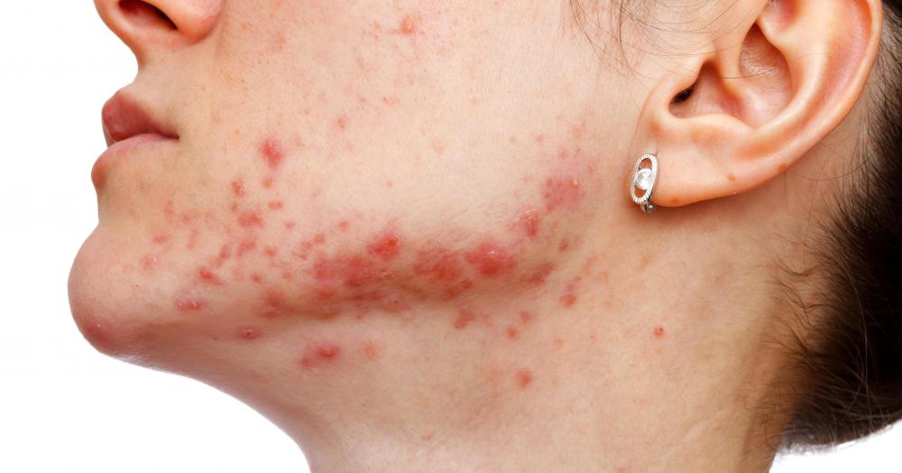 What Is Cystic Acne with Pictures What Is Cystic Acne with Pictures
