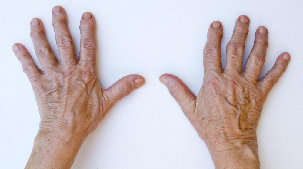 What Is The Connection Between Sarcoidosis And Arthritis 