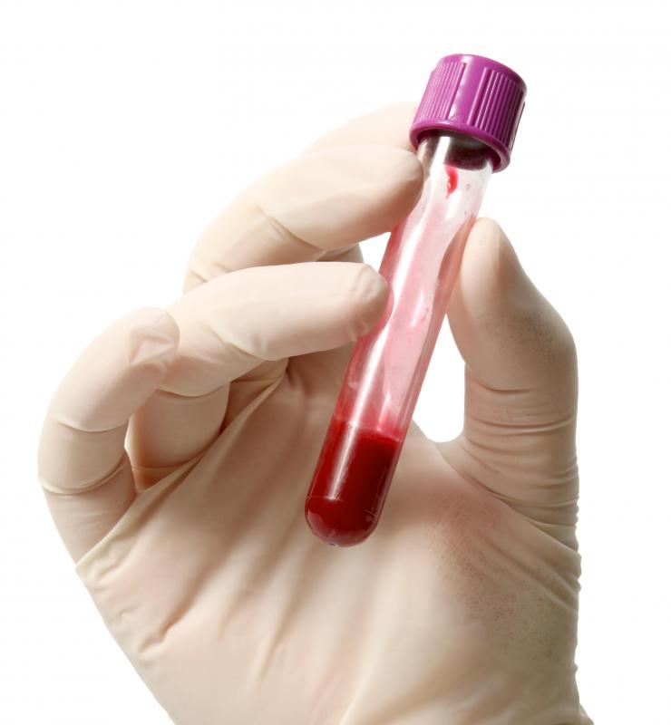 How Do I Give Bone Marrow with Pictures How Do I Give Bone Marrow with Pictures