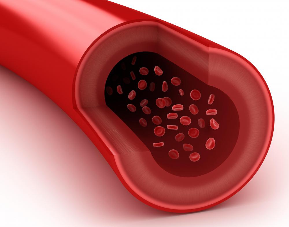 What Causes Hardened Arteries with Pictures What Causes Hardened Arteries with Pictures