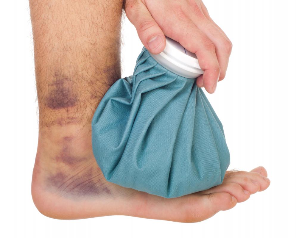 What Is A Contusion with Pictures 