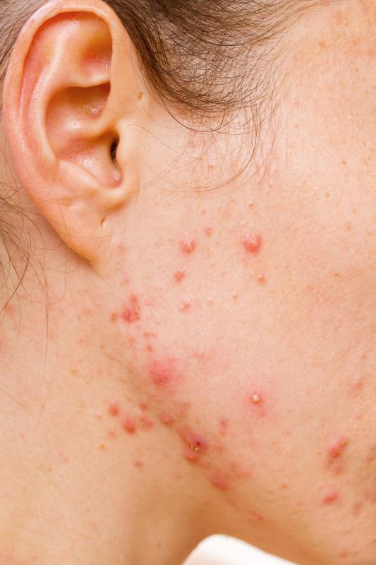 What Causes Itching Skin Bumps with Pictures What Causes Itching Skin Bumps with Pictures
