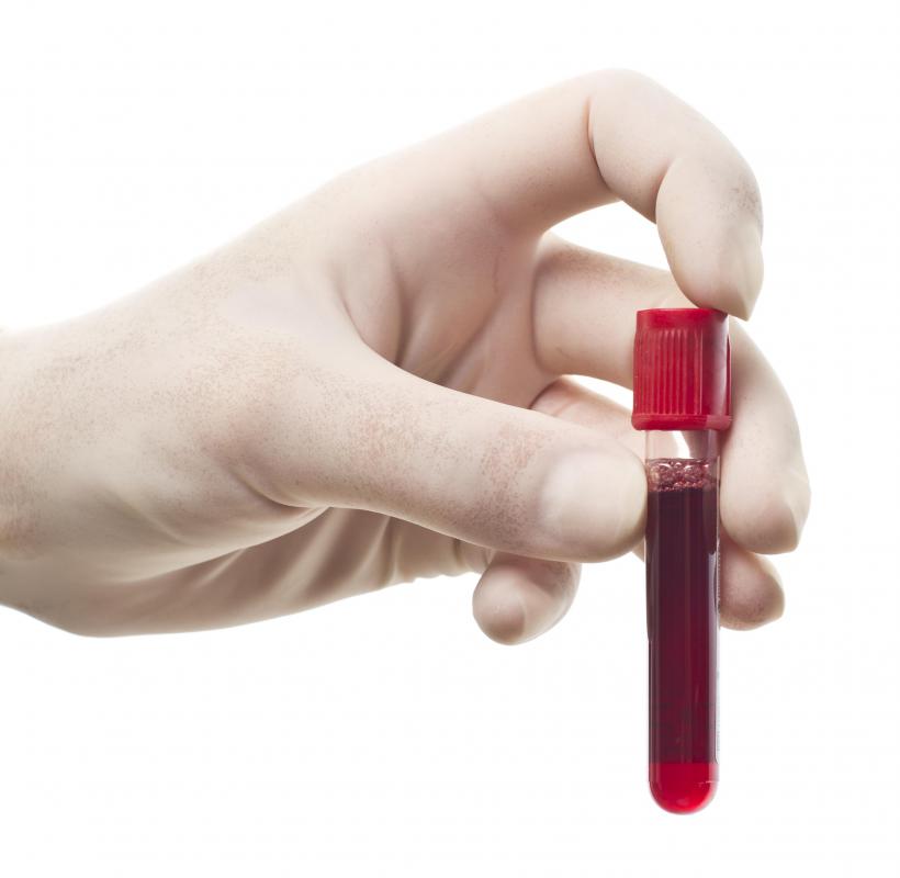 What Is The Blood Urea Nitrogen Test with Pictures 