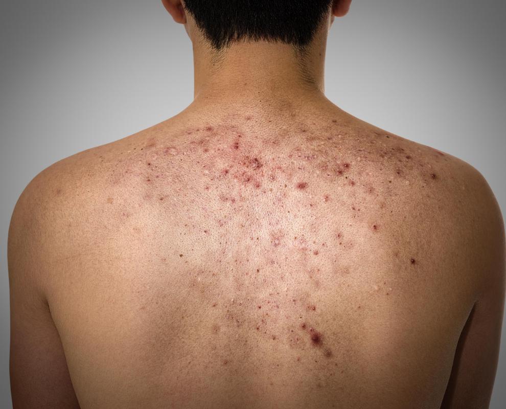 How Do I Get Rid Of Back Blemishes with Pictures How Do I Get Rid Of Back Blemishes with Pictures