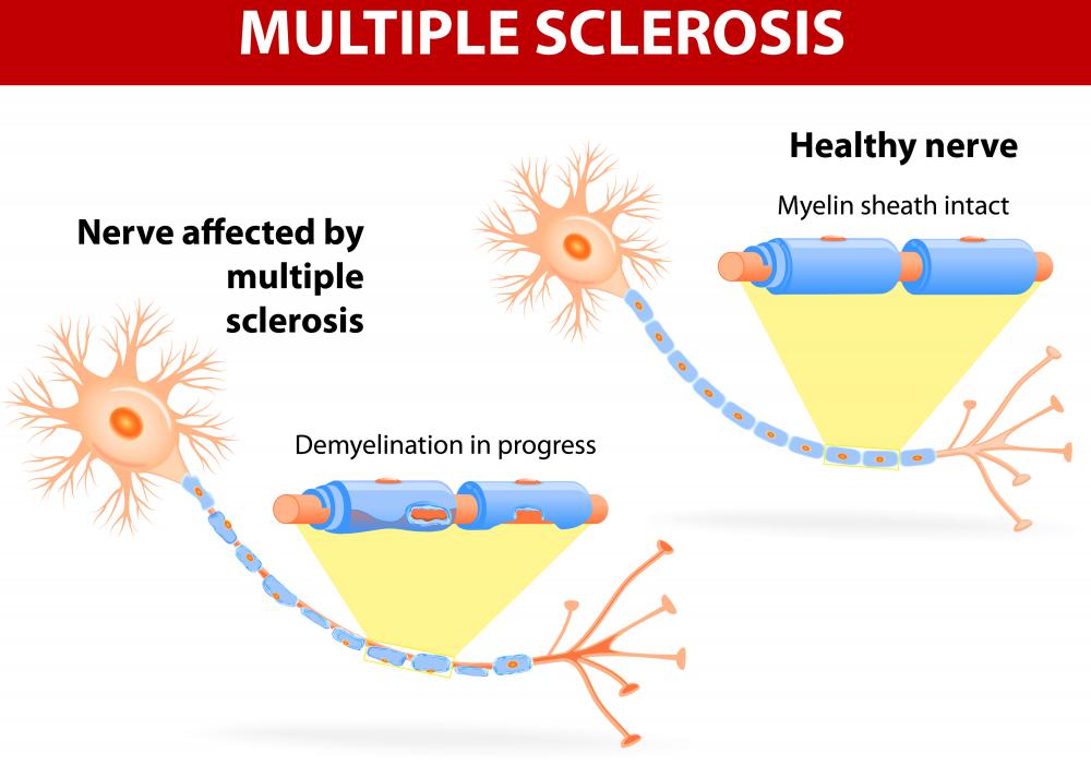 What Are The Different Types Of Nervous System Disorders 