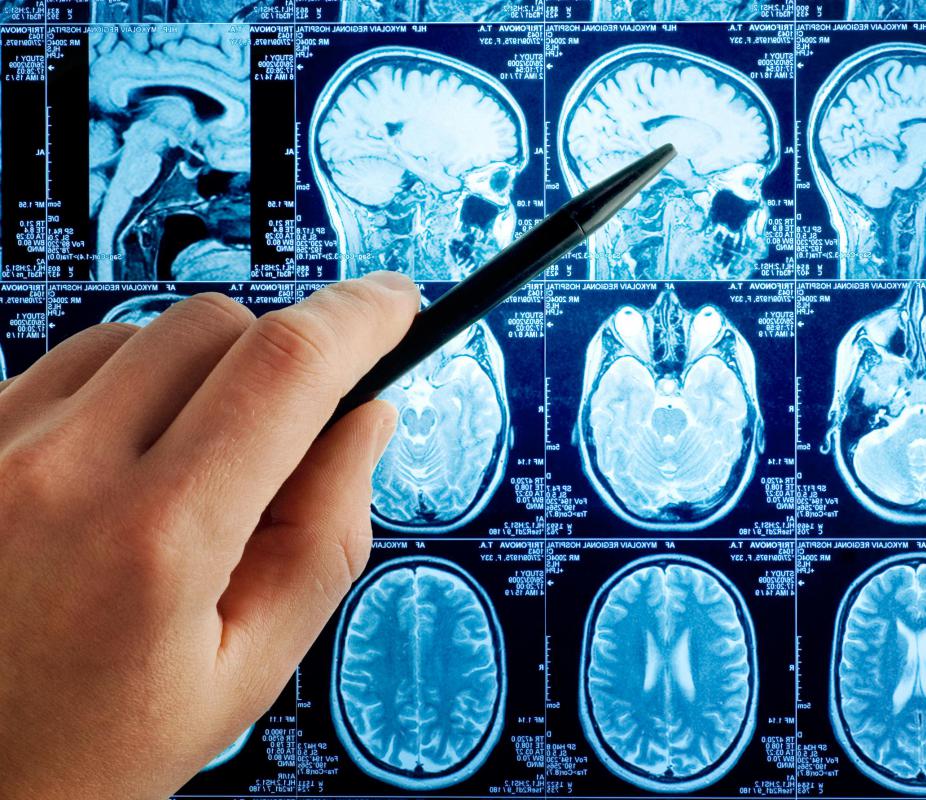 What Is The Prefrontal Cortex with Pictures 