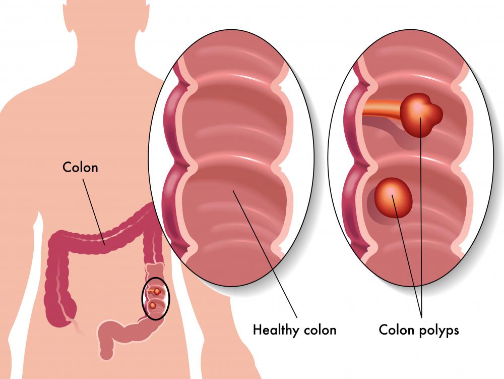 What Is A Colon Lesion with Pictures 