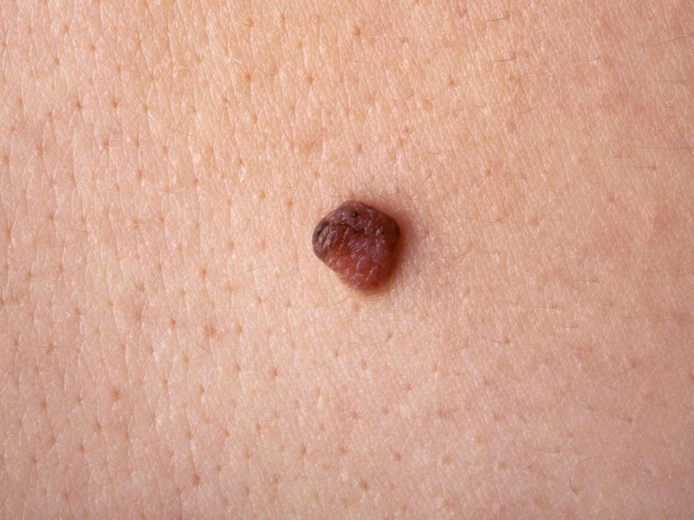 How Do Doctors Remove Moles with Pictures 