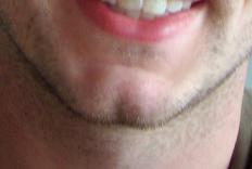 What Is a Cleft Chin? (with pictures)