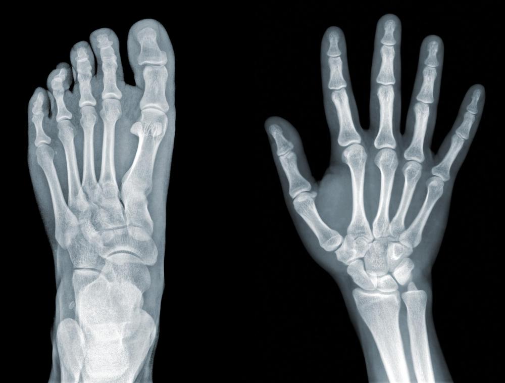 How Do I Treat A Sprained Hand with Pictures 