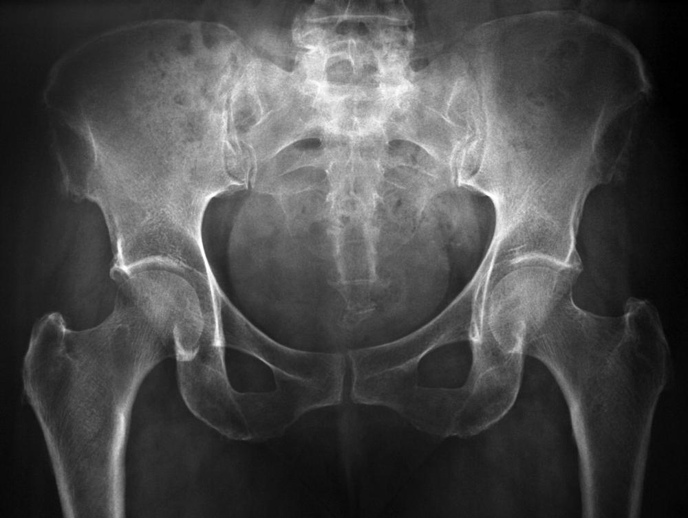 What Is Femoroacetabular Impingement with Pictures What Is Femoroacetabular Impingement with Pictures